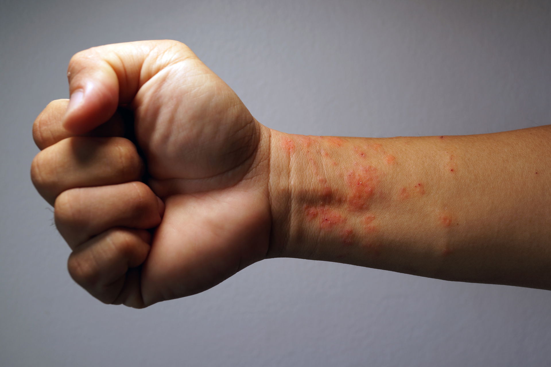 Neurodermitis an der Hand: Wie man pflegt und vorbeugt