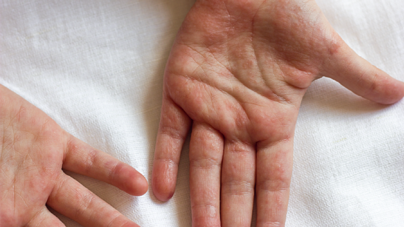 Neurodermitis an der Hand: Wie man pflegt und vorbeugt