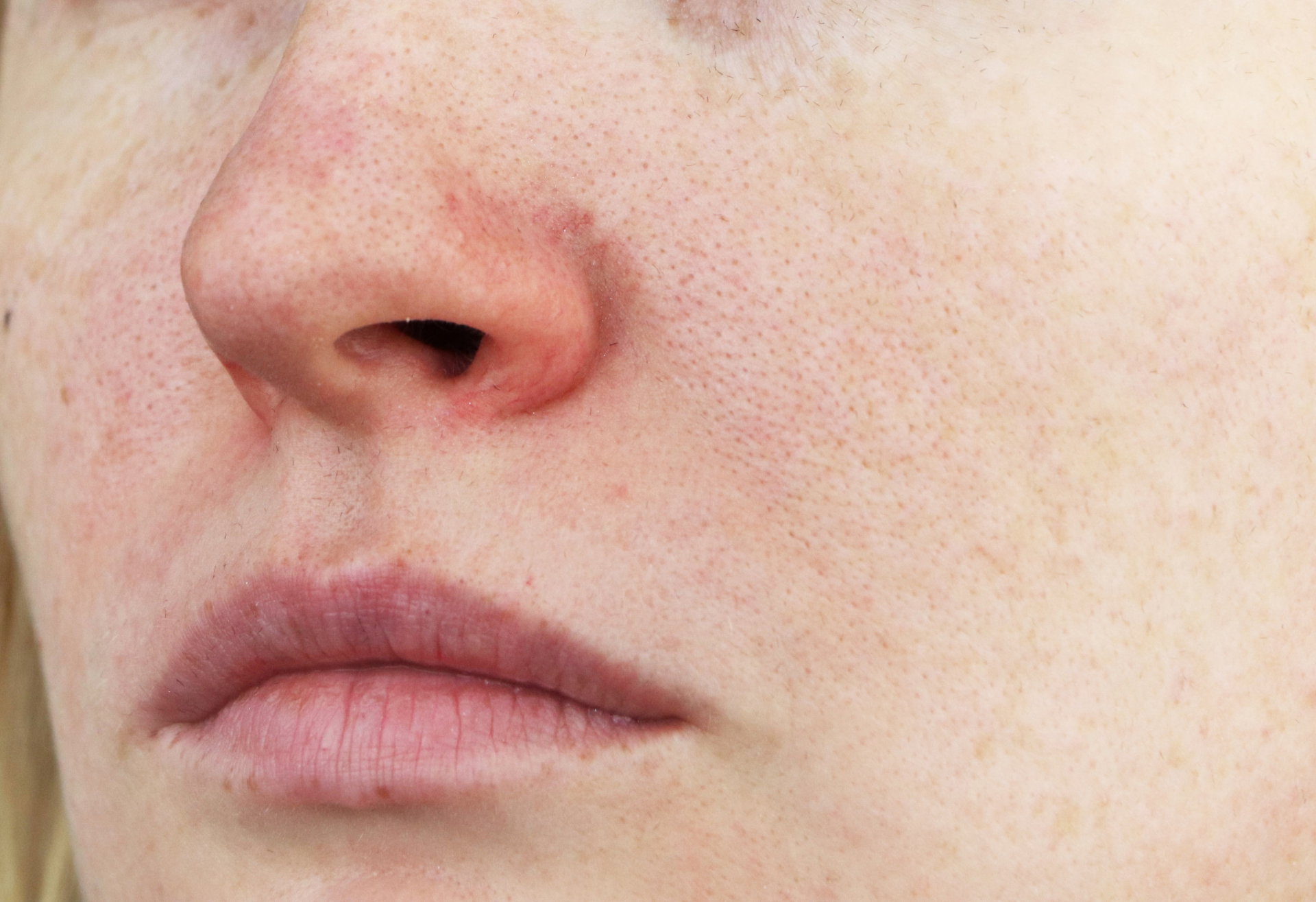 Rosacea: Symptome, Trigger & Behandlung geröteter Haut